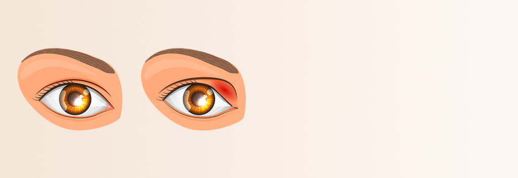 Orgelet / Chalazion - Ophtalmo Expert