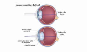 Presbytie - Ophtalmo Expert