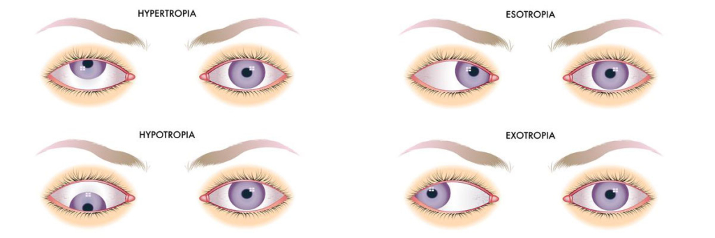 Strabisme - Ophtalmo Expert